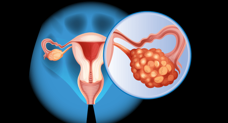 What Are Ovaries? Understanding Their Role in Women’s Health